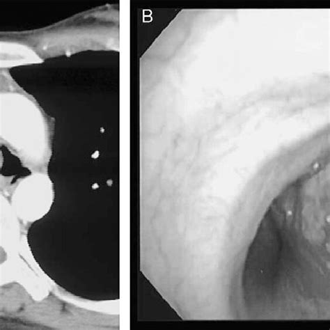 A Chest Computed Tomography Demonstrates A Polypoid Tumor In The Lower