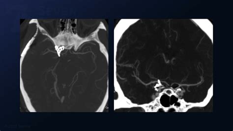154 Clipping Of A Superior Hypophyseal Artery Aneurysm With Extra