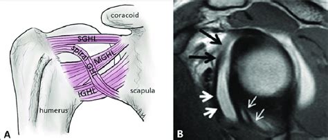 Glenohumeral Ligaments And Spiral Glenohumeral Ligament Fasciculus