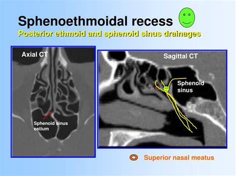 Sphenoethmoidal Recess