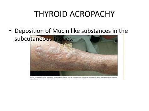 Hyperthyroidism Clinical Features And Its Management Ppt