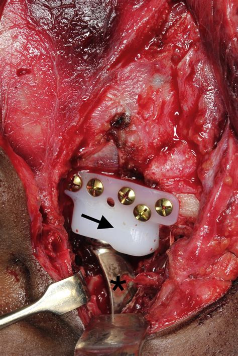 Reconstructed Temporomandibular Joint And Glenoid Fossa Component Download Scientific Diagram