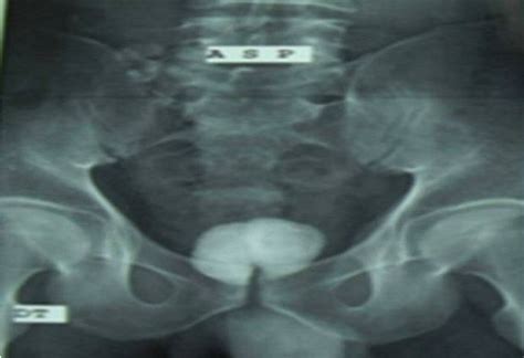 Kub Showing Two Giant Prostatic Calculi Download Scientific Diagram