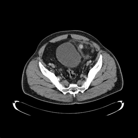 Abscess Diverticulitis At Maddison Westacott Blog