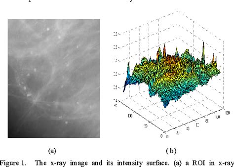 Figure 1 From Svm Based Microcalcification Detection In Digital Mammograms Semantic Scholar
