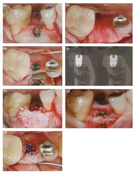 采用块状骨vs颗粒状骨替代材料进行种植体周围缺损引导骨再生后的硬组织变上海九院口腔种植科主任赖红昌