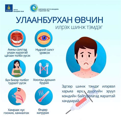 Булган Аймгийн УЛААНБУРХАН ӨВЧИН ГЭЖ ЮУ ВЭ Улаанбурхан гэдэг нь нусгайрах халуурах нүд