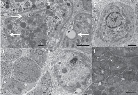 Multisystem Disorder Semantic Scholar