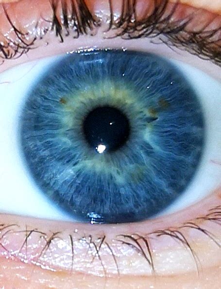 My Heterochromia Iridum Heterochromia