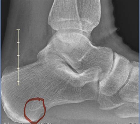 Do I Have A Calcaneal Stress Fracture X Ray Included R Diagnoseme