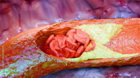 Cholesterrol Or Atherosclerotic Plaque In Blood Vessels Blocked Vessel