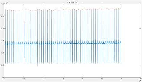 使用 Matlab 心电数据捕获心率r峰提取后怎么计算心率 Csdn博客