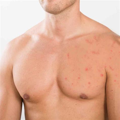 How To Get Rid Of Chest Acne The Expert Dos And Donts