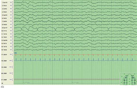 ICU Continuous EEG Monitoring Neupsy Key