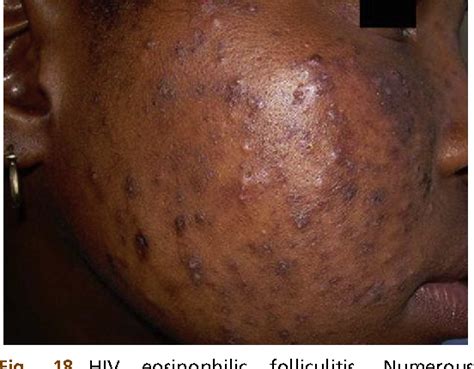 Hiv Rash Face