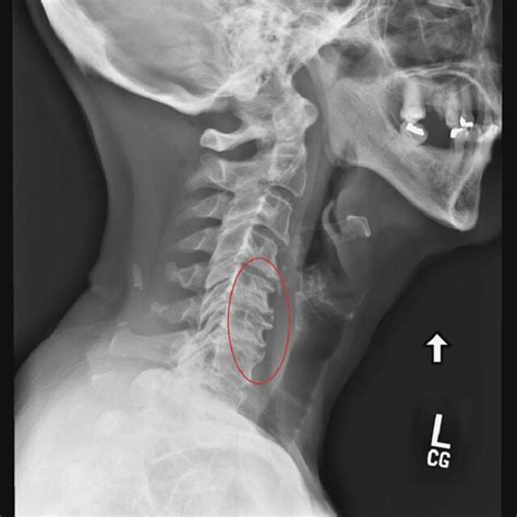 Lateral View X Ray Of The Cervical Spine Illustrating Cervical Download Scientific Diagram