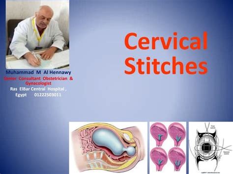 Cervical Cerclage Procedure Ppt