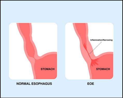 Eosinophilic Esophagitis Eoe Defined Food Allergy Canada
