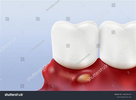 Gingivitis Swollen Gums That Form Pustules Stock Vector Royalty Free