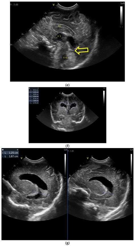 Cranial Ultrasound In The Management Of Hydrocephalus In Newborns A