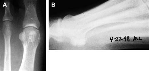 Sesamoid Disorders Of The First Metatarsophalangeal Joint Clinics In