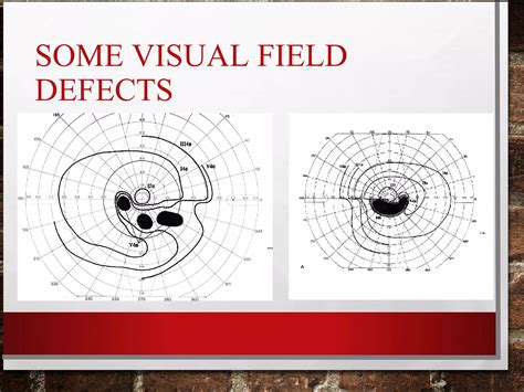 Visual Field Testing And Interpretation Ppt Eye And Vision Conditions Diseases And Conditions