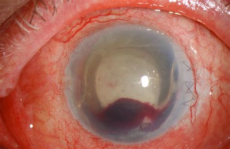 Moran Core Hyphema