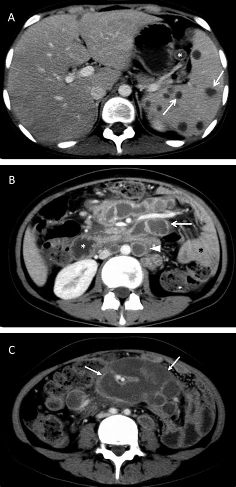 Para Aortic Lymph Nodes