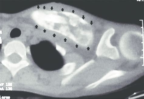 Ct Scan Bony Window Axial Section Showingheterogeneous Ossification