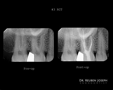 3 Pulpitis Er Rct Tdo University