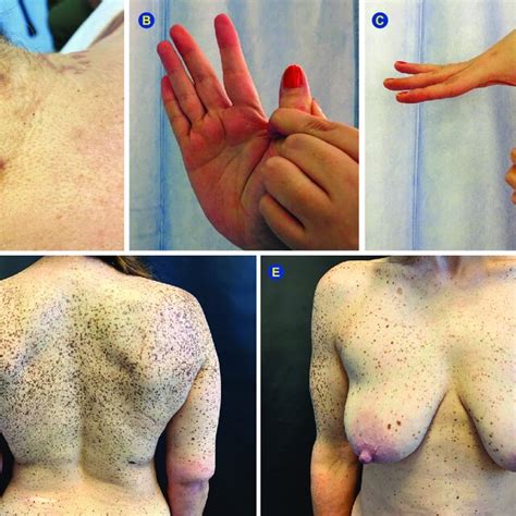 A Elastosis Perforans Serpiginosa A Cluster Of Small Papules