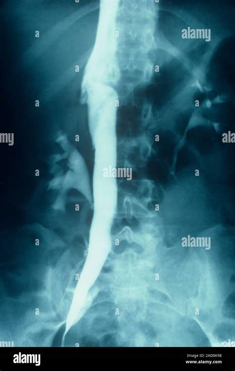 Deep Vein Thrombosis X Ray Venogram Of A Section Through The Abdomen