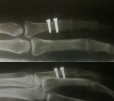 Травмы кисти и стопы перелом ладьевидной кости перелом пяточной кости травмы плюсневых