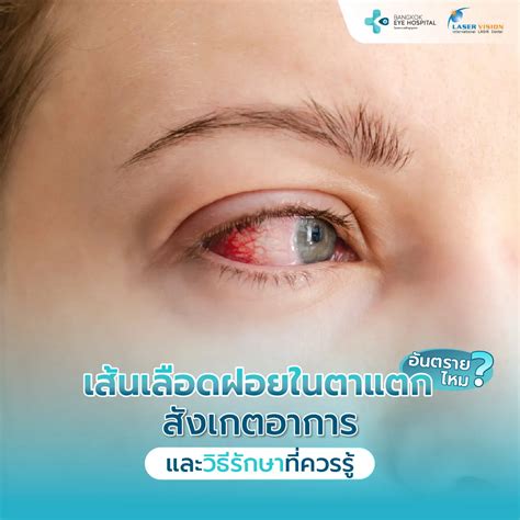 Subconjunctival Hemorrhage Causes Symptoms And Treatment Bangkok Eye Hospital