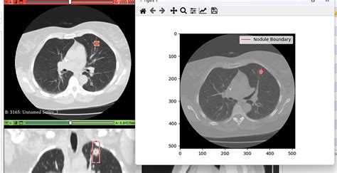 Using Monai Label To Fine Tune The Vessel Segmentation Support 3d Slicer Community