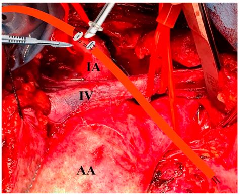 Direct Innominate Artery Cannulation For Thoracic Aortic Surgery