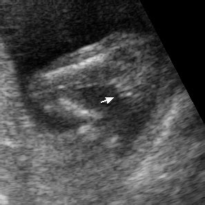 Early Gender Girls 14 Weeks 3d 4d Hd Ultrasound Virginia