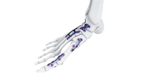 TriLEAP Lower Extremity Anatomic Plating System DePuy Synthes J J MedTech US