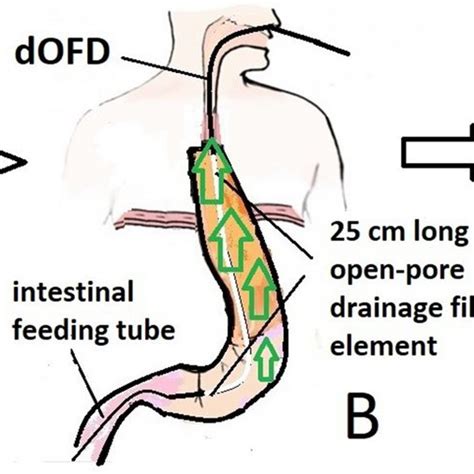 Schematic Illustration Of The Pard Method A Without A Nasogastric Tube Download Scientific