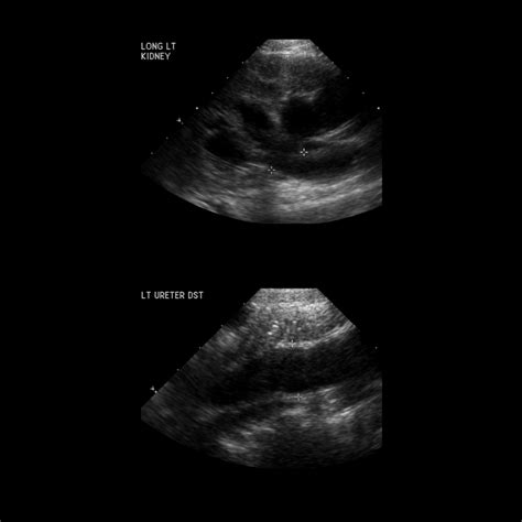 Congenital Megaureter Pediatric Radiology Reference Article
