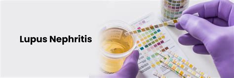 Know About Lupus Nephritis Symptoms Causes And Treatments