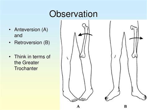 Femoral Anteversion Vs Tibial Torsion