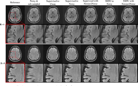 Figure 2 From Clean Self Supervised Mri Reconstruction From Noisy Sub Sampled Training Data