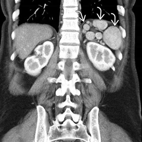 Asplenia And Polysplenia Radiology Key