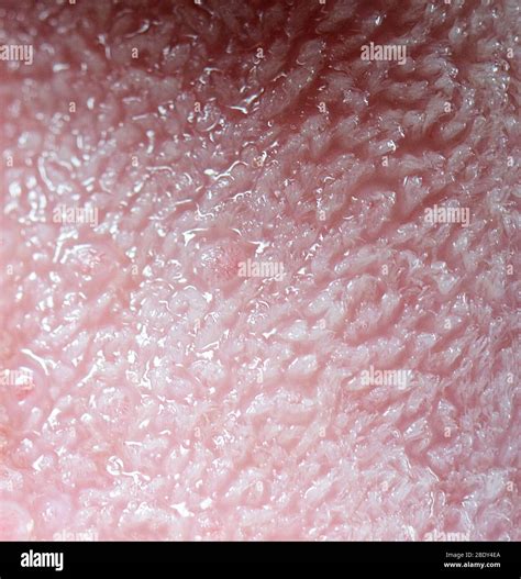 Circumvallate Papillae Side Of Tongue