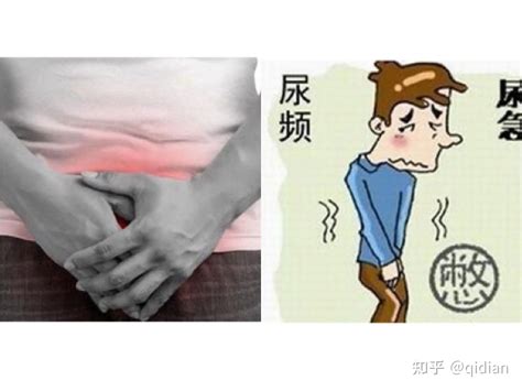 前列腺炎好不了？ 知乎