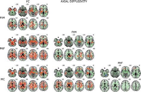Effects Of Gender Identity And Sex On Regional AD See Schema In Figure Download Scientific