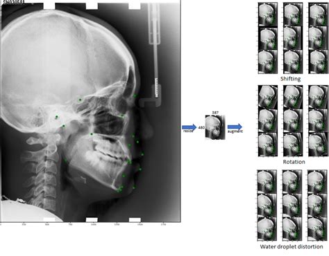 Locating Cephalometric Landmarks With Multi Phase