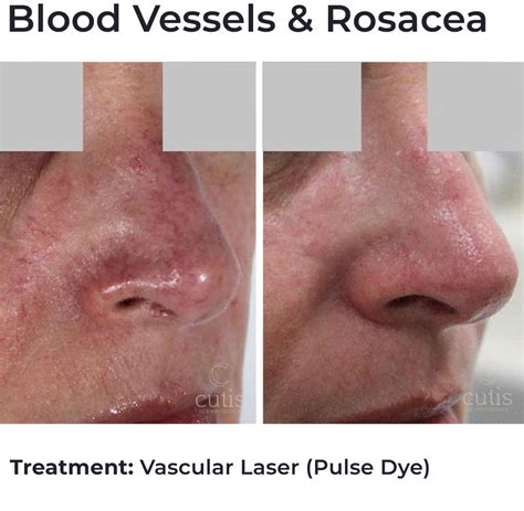 Best Rosacea Treatment Packages Brisbane Cutis Dermatology