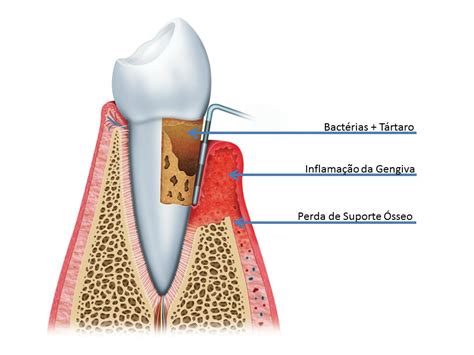 Periodontite Periodontia Periodontia Periodontite Restauração Dente